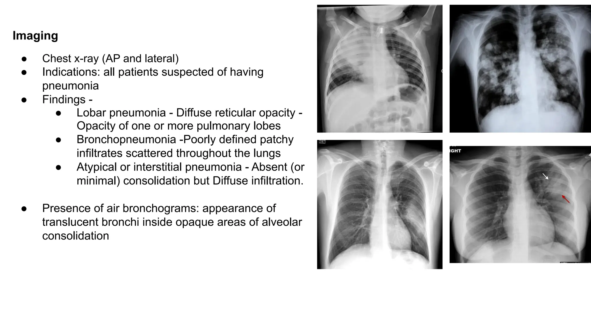 Pneumonia in children.pdf Pediatric presentation | PDF