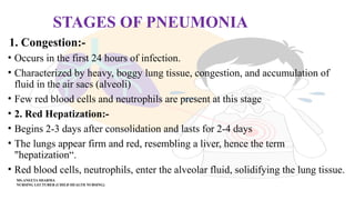 Pneumonia in children. pptx | PPTX