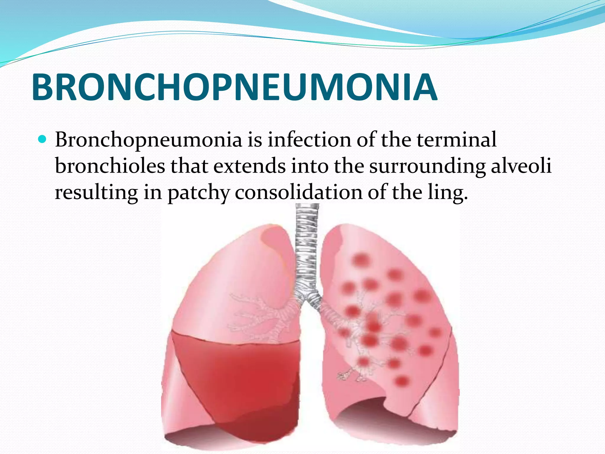Pneumonia, Introduction ,Pathogenesis ,lab diagnosis and treatment | PPTX