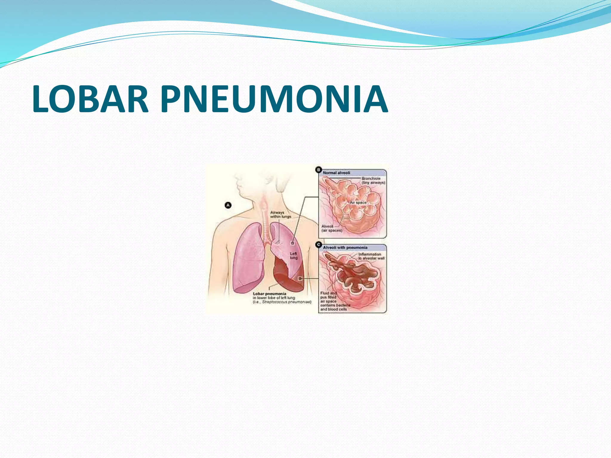 Pneumonia, Introduction ,Pathogenesis ,lab diagnosis and treatment | PPTX