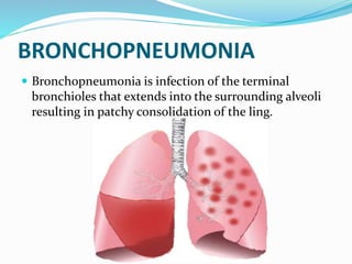 Pneumonia, Introduction ,Pathogenesis ,lab diagnosis and treatment | PPTX