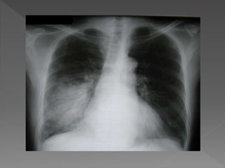 Pneumonia nice gl | PPTX