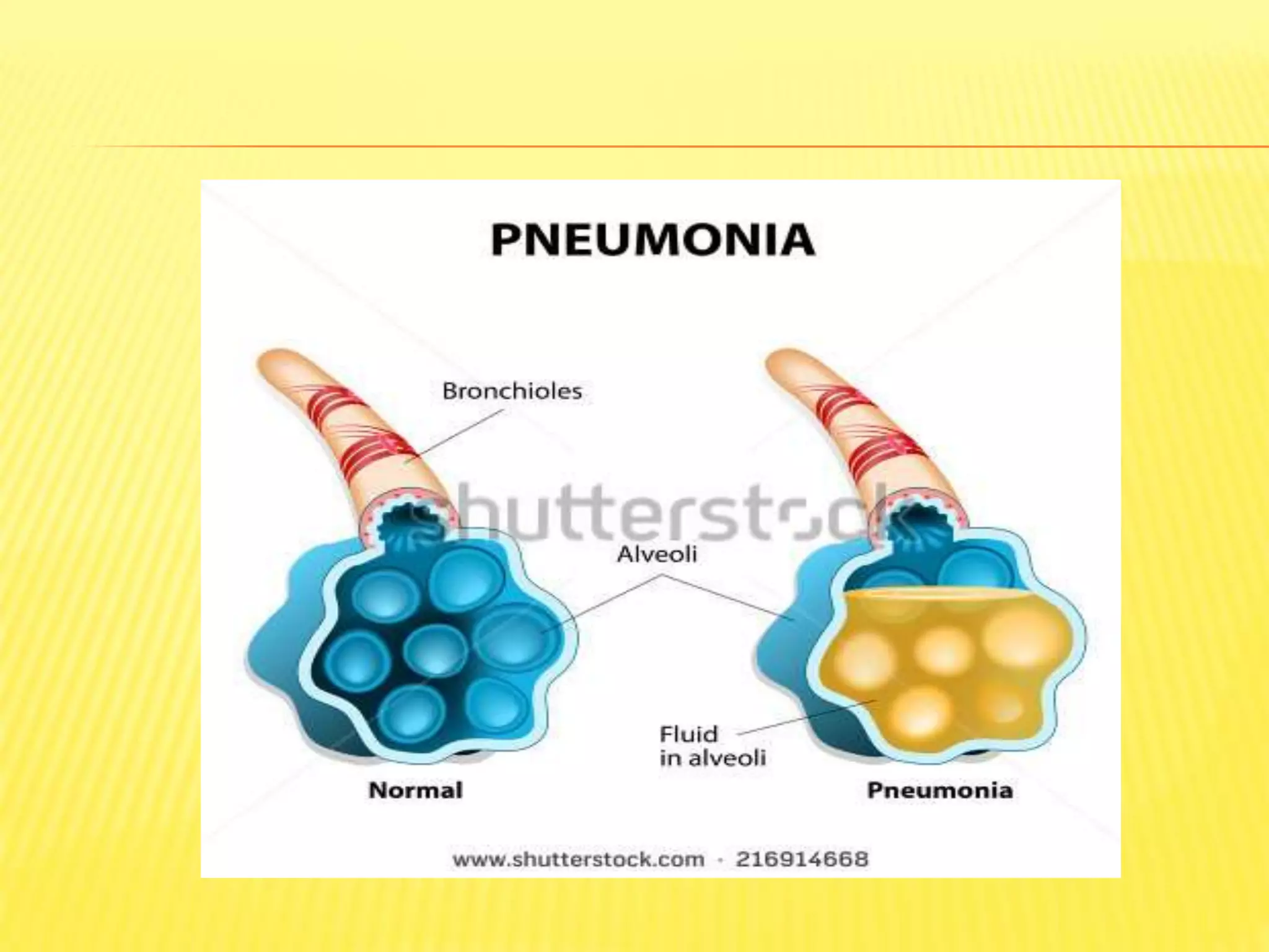 Pneumonia ppt | PPT