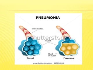 Pneumonia ppt | PPT