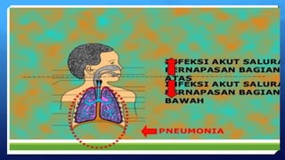 Pneumonia_PPT.pptx