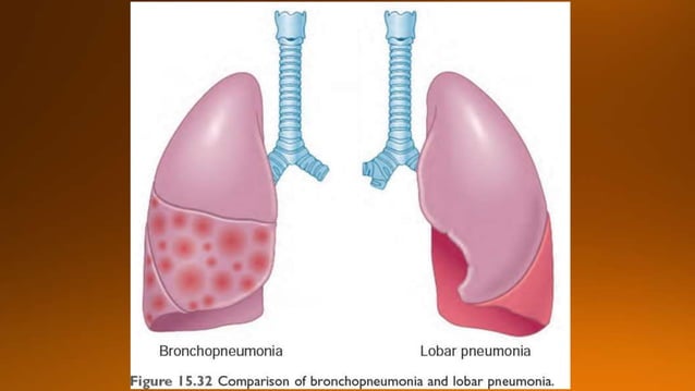 Pneumonia presentation peads unit ii children hospital larkana.pptx