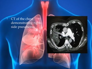 Pneumonia (propdeutics) | PPT