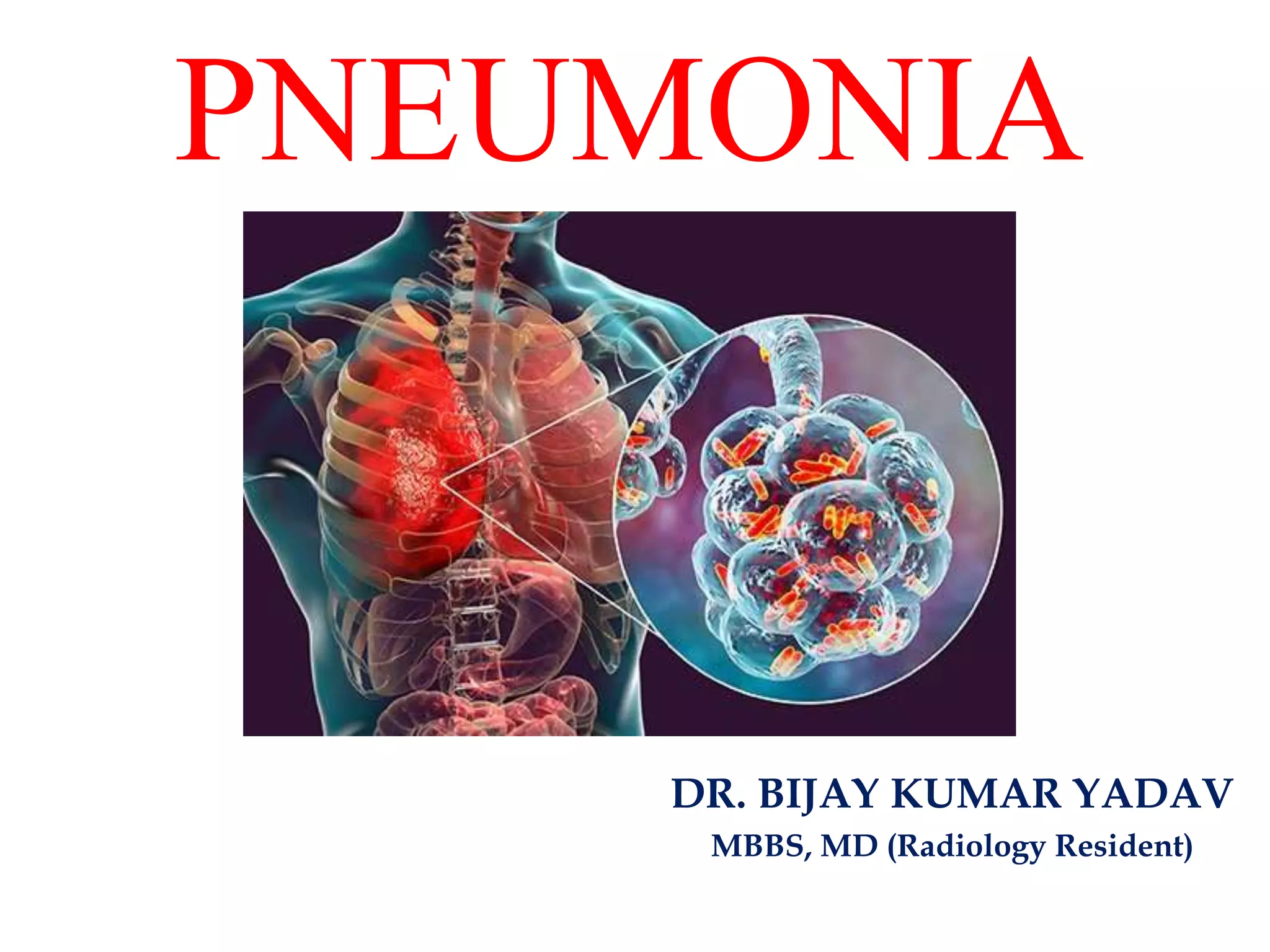 Pneumonia Radiology | PPTX