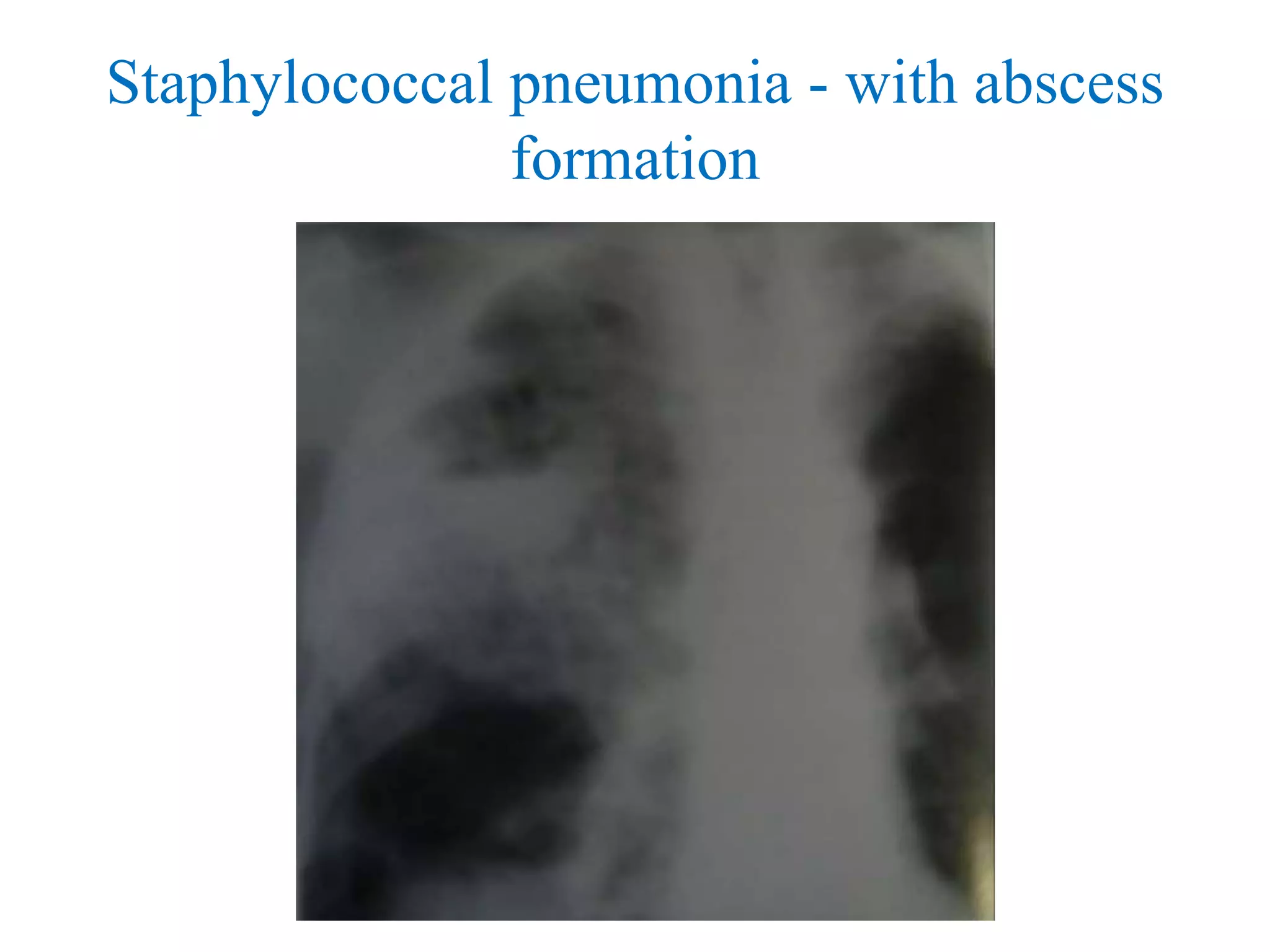 Pneumonia Radiology | PPTX