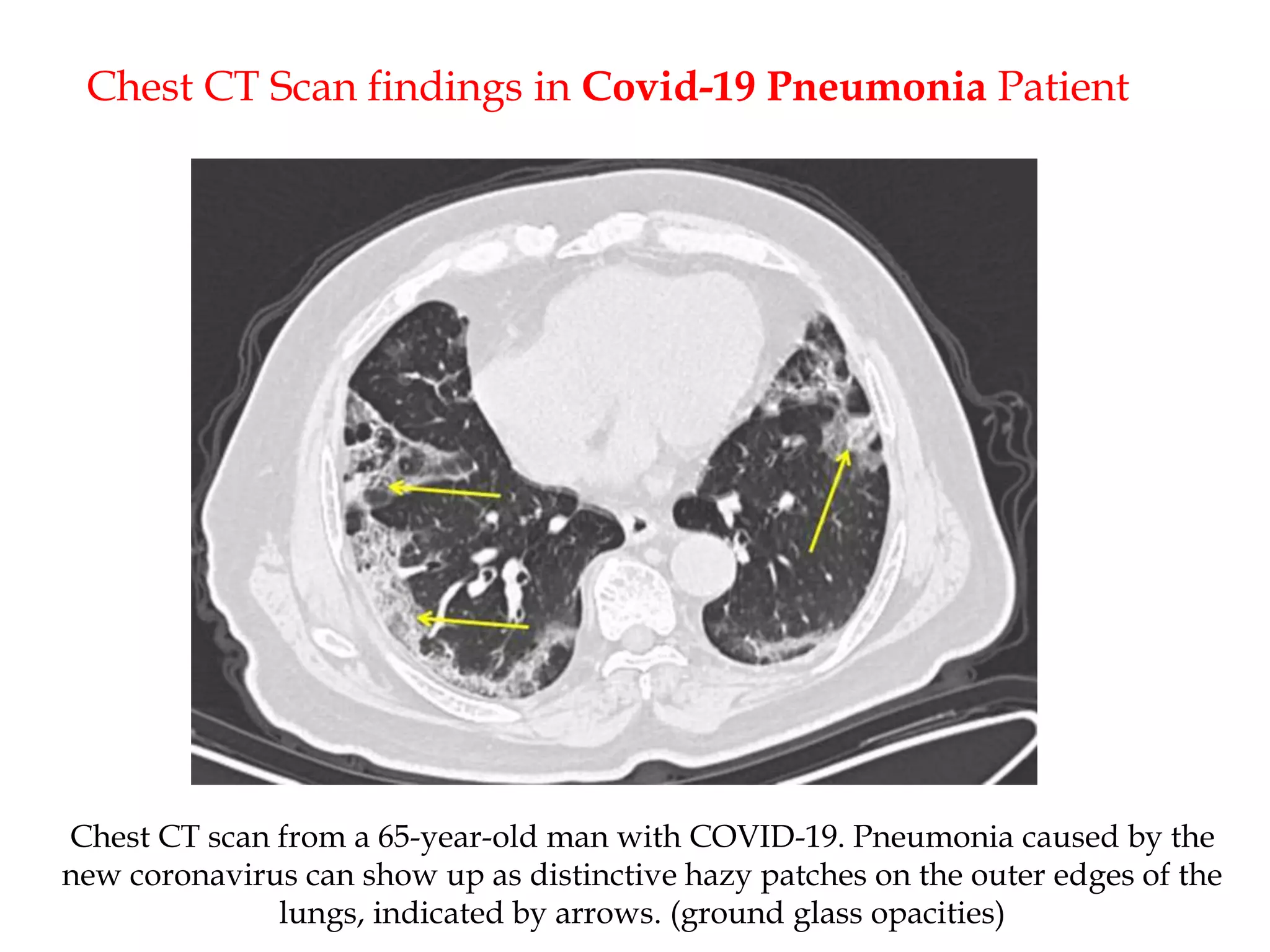 Pneumonia Radiology | PPTX
