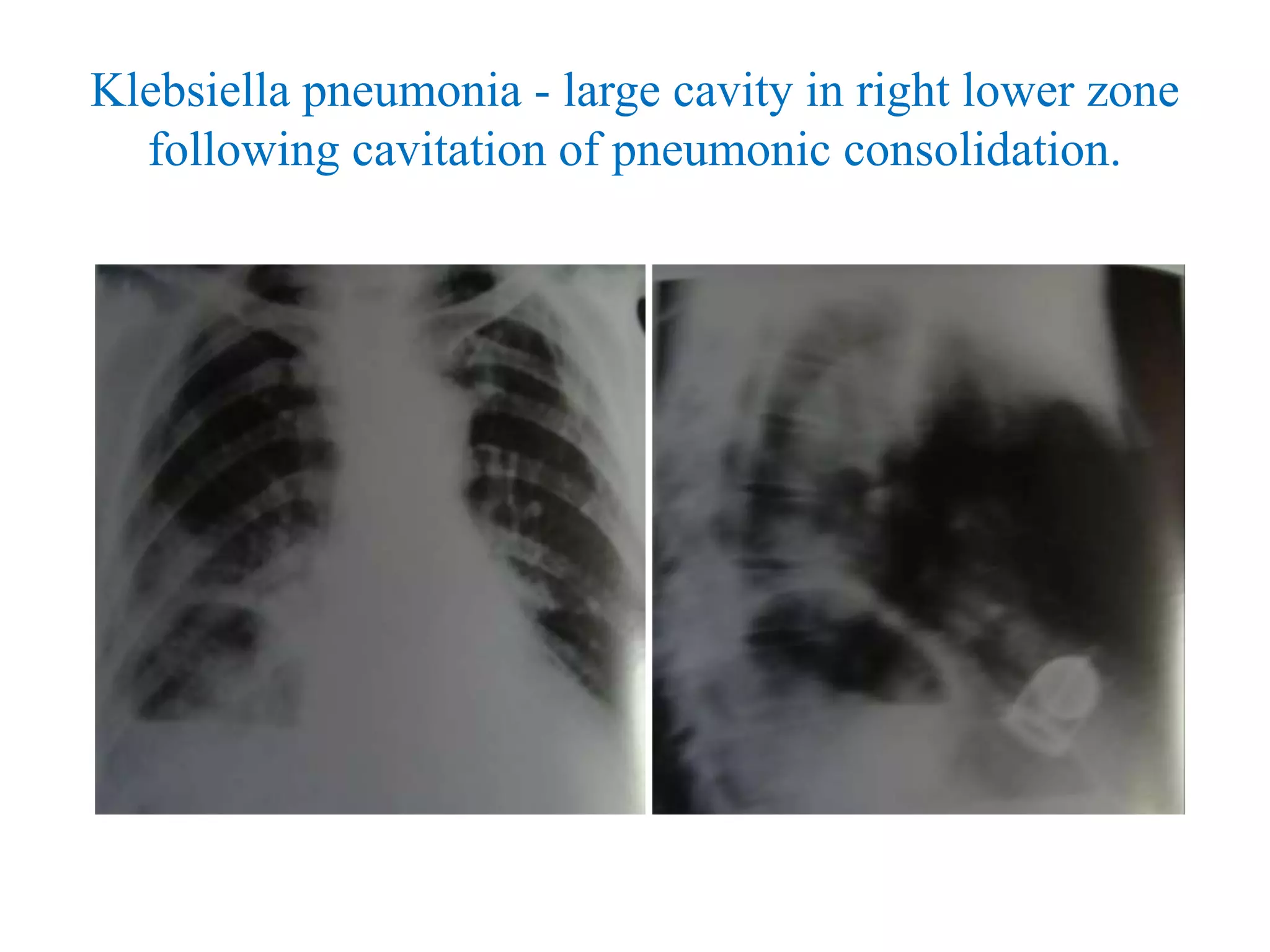 Pneumonia Radiology | PPTX