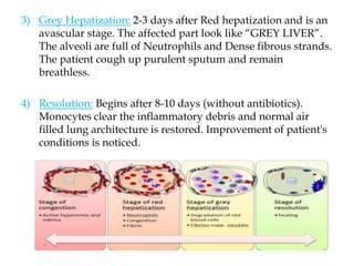 Pneumonia Radiology | PPTX