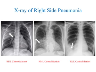 Pneumonia Radiology | PPTX