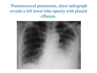 Ventilator Associated Pneumonia Xray