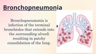 Pneumonia Respiratory infection.pptx