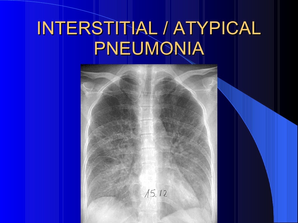 Atypical Pneumonia