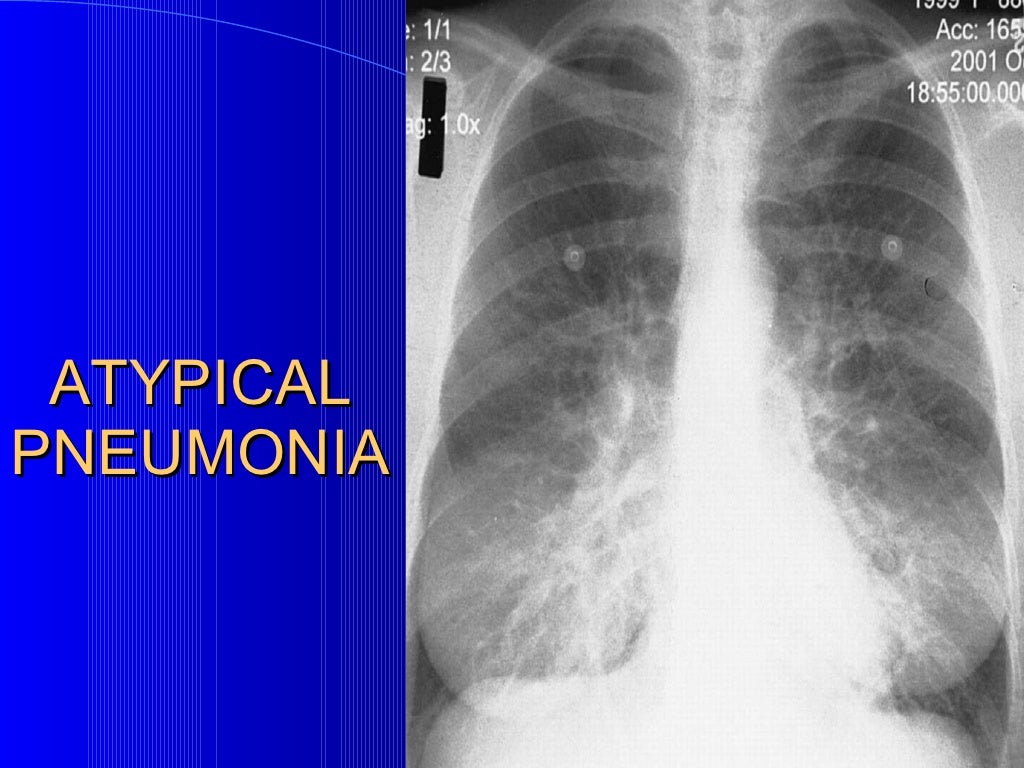 Atypical Pneumonia