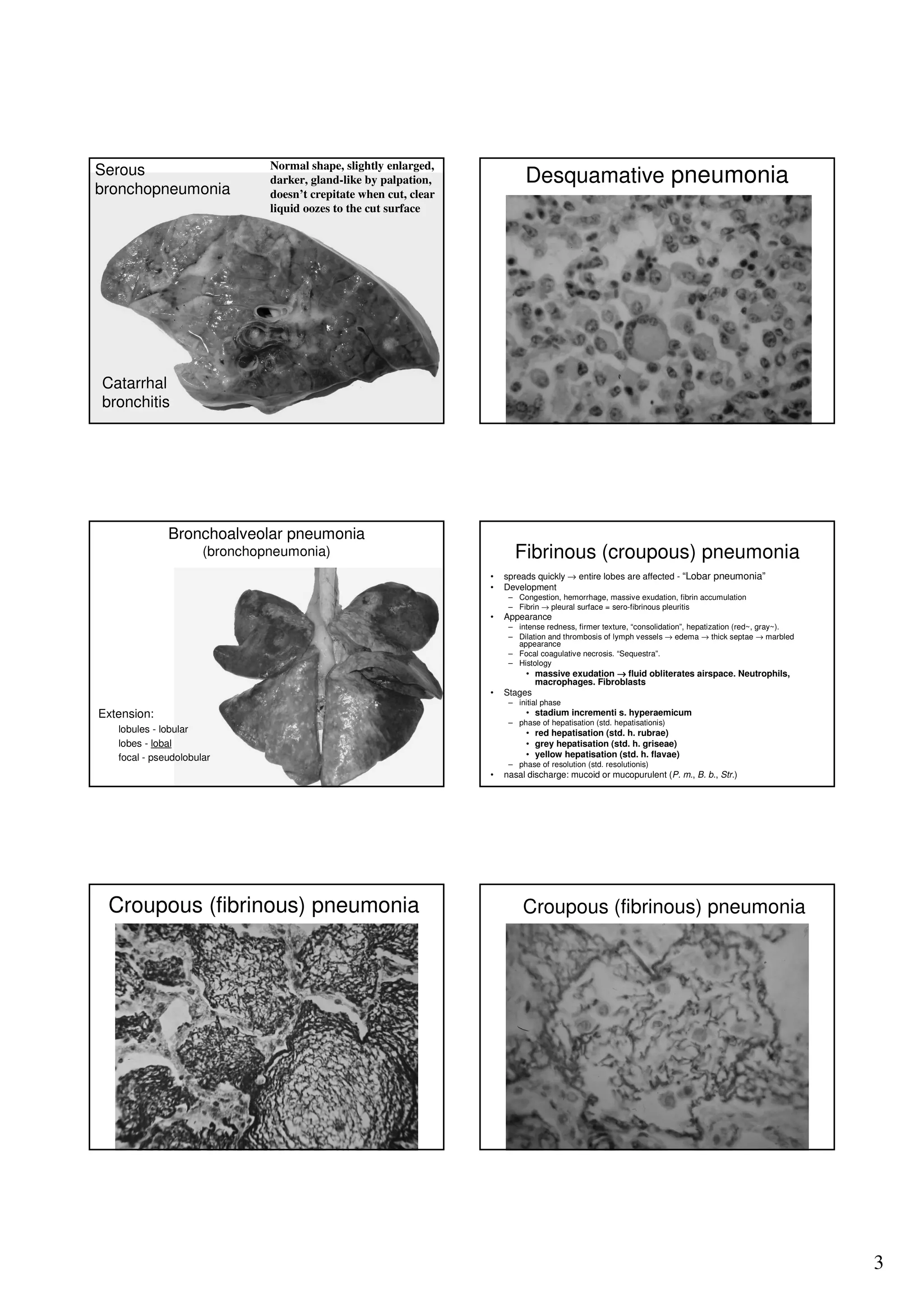 Pneumonia subtypes | PDF