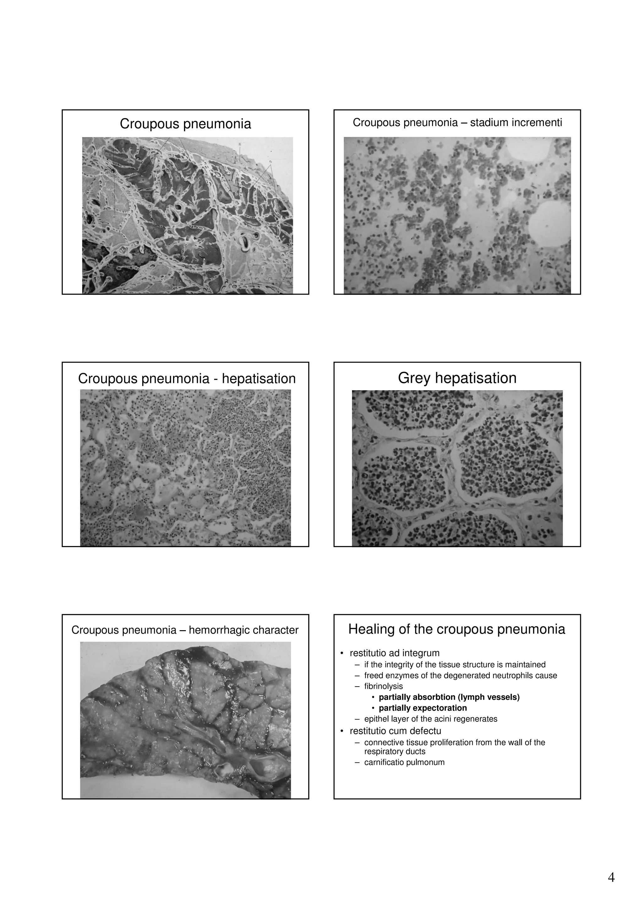 Pneumonia subtypes | PDF