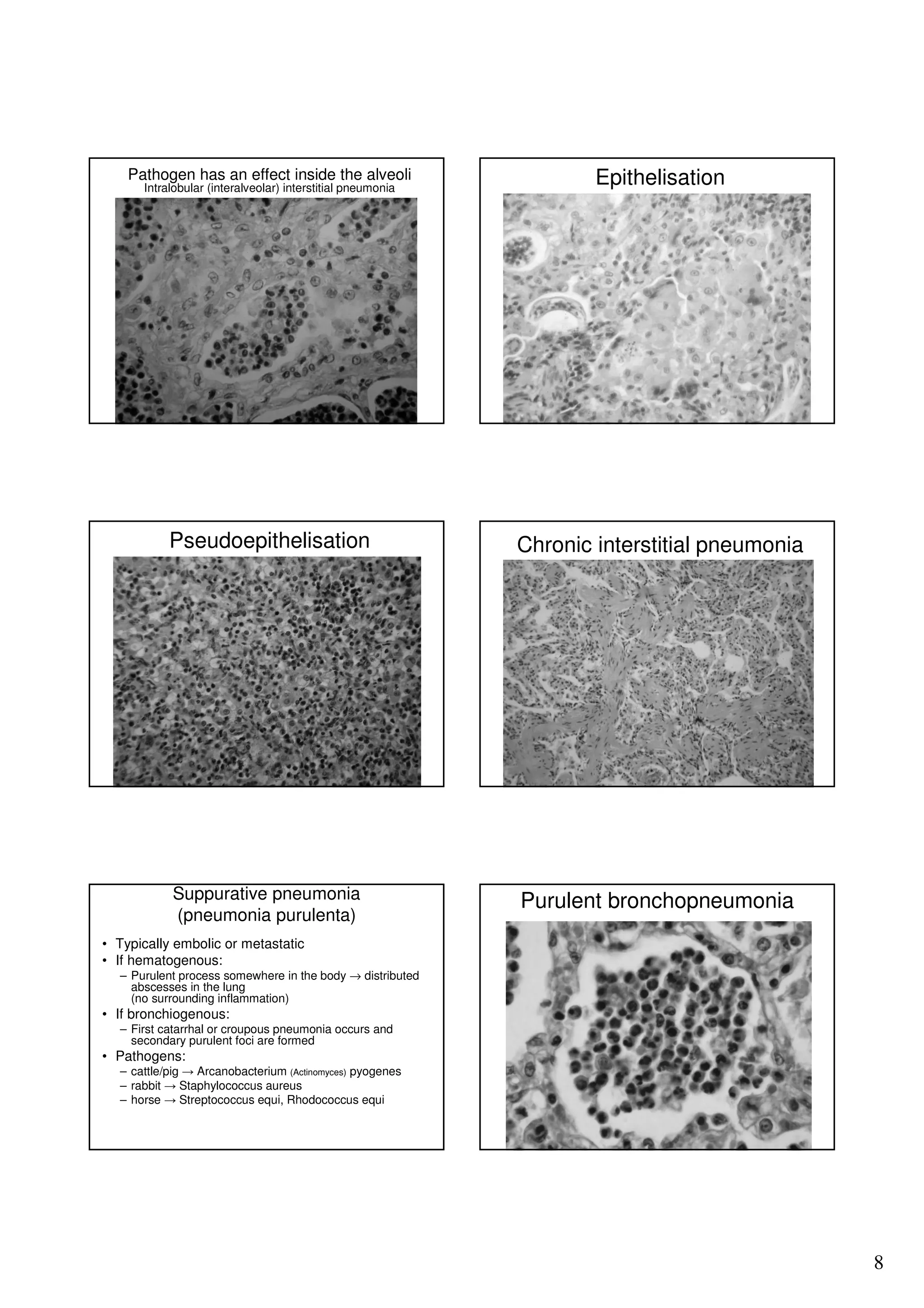 Pneumonia subtypes | PDF