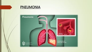 Pneumonia Topic Presentation ppt by Dr Muhammad Hassan | PPT