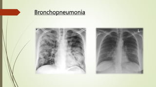 Pneumonia Topic Presentation ppt by Dr Muhammad Hassan | PPT