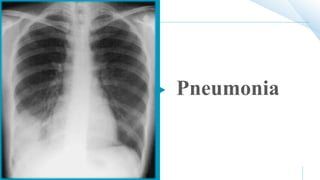 Pneumonia cases | PPTX