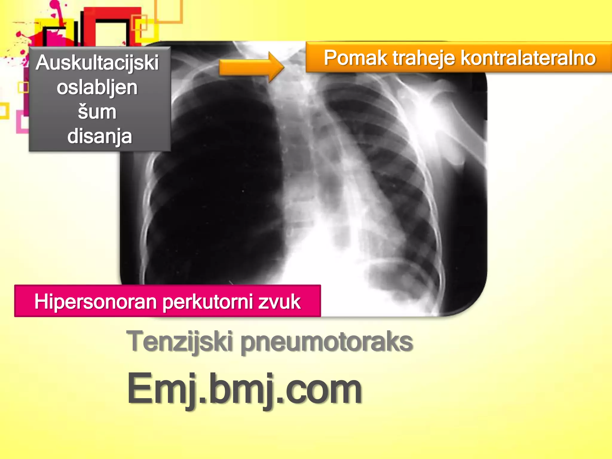 Pneumonija s empijemom | PPSX