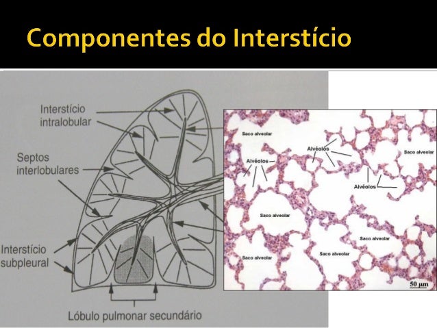 Pneumopatias Intersticiais