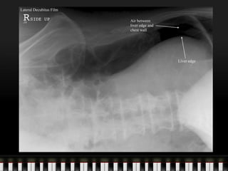 Pneumoperitoneo_2011.ppt