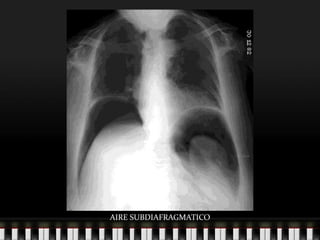 Pneumoperitoneo_2011.ppt