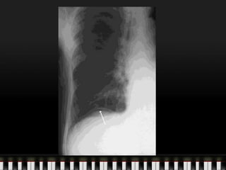 Pneumoperitoneo_2011.ppt