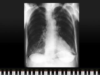 Pneumoperitoneo_2011.ppt
