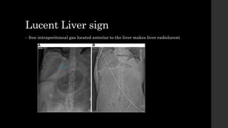 Pneumoperasdgasdgfasdgasdgsadgitoedum.pptx