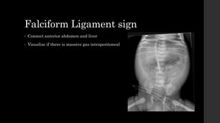 Pneumoperasdgasdgfasdgasdgsadgitoedum.pptx