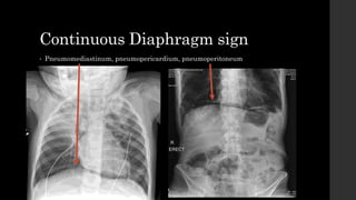 Pneumoperasdgasdgfasdgasdgsadgitoedum.pptx