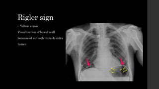 Pneumoperasdgasdgfasdgasdgsadgitoedum.pptx