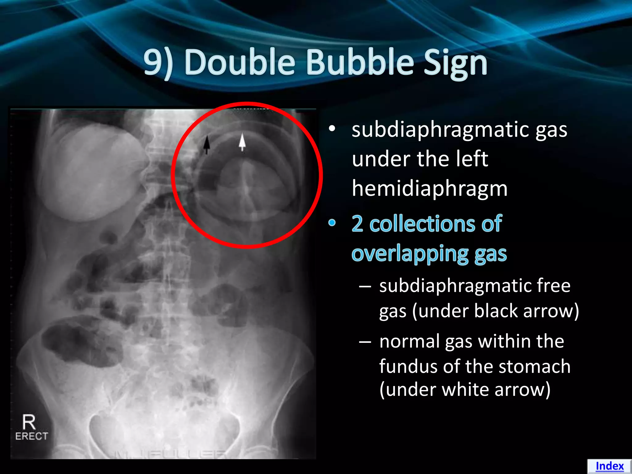 Signs of Pneumoperitoneum on Plain Film | PPTX