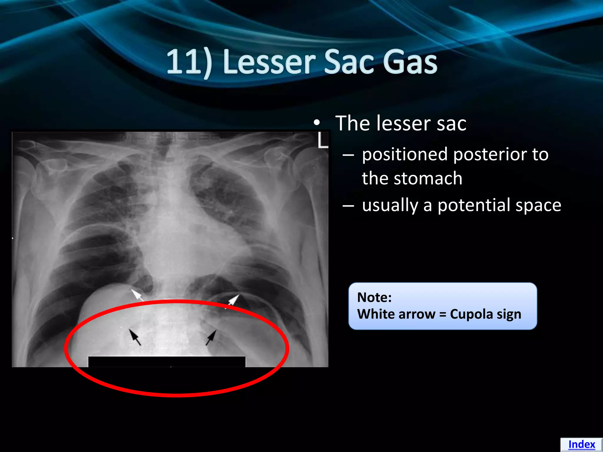 Signs of Pneumoperitoneum on Plain Film | PPTX