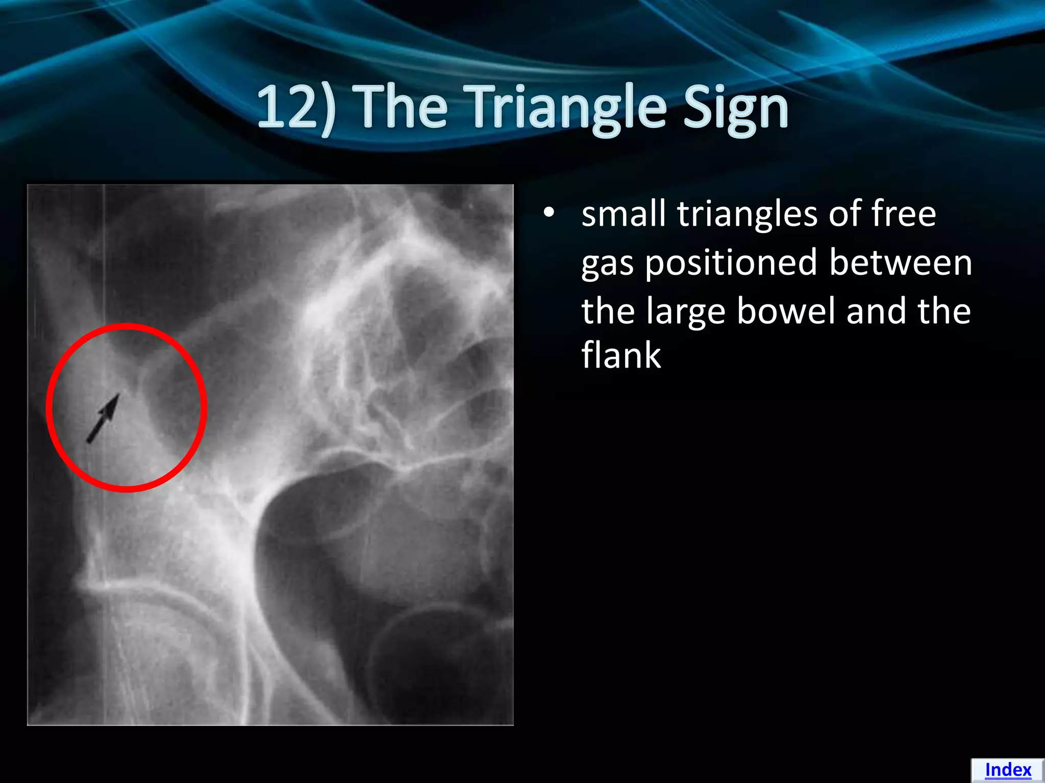 Signs of Pneumoperitoneum on Plain Film | PPTX