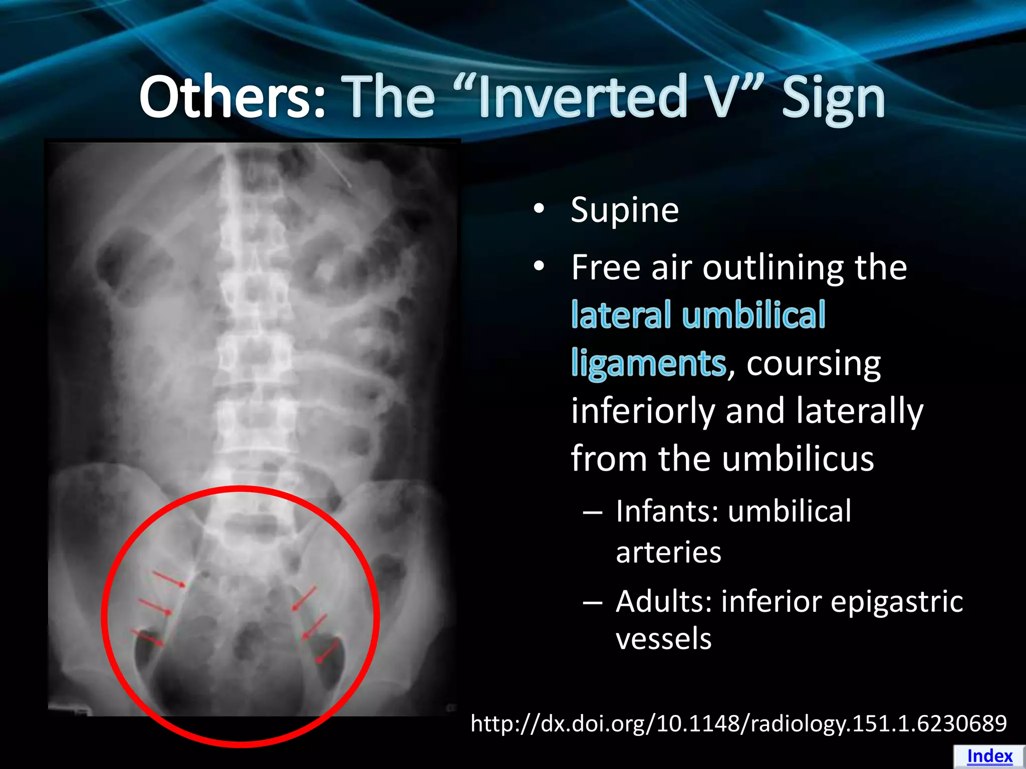 Signs of Pneumoperitoneum on Plain Film | PPTX