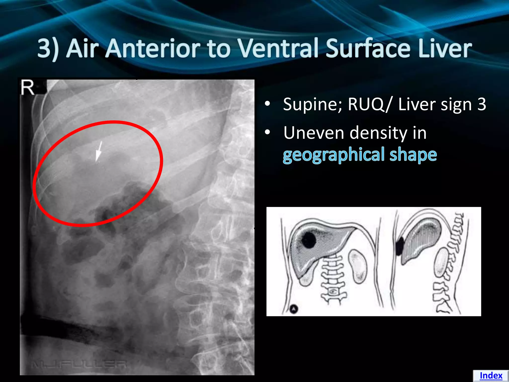 Signs of Pneumoperitoneum on Plain Film | PPTX