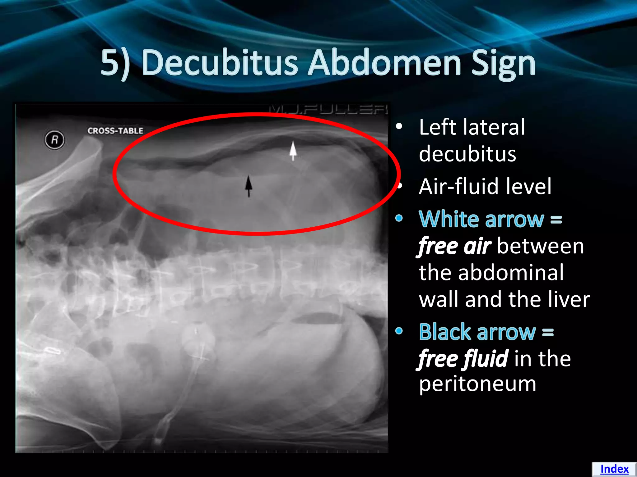 Signs of Pneumoperitoneum on Plain Film | PPTX