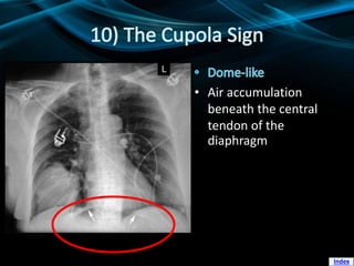 Signs of Pneumoperitoneum on Plain Film | PPTX