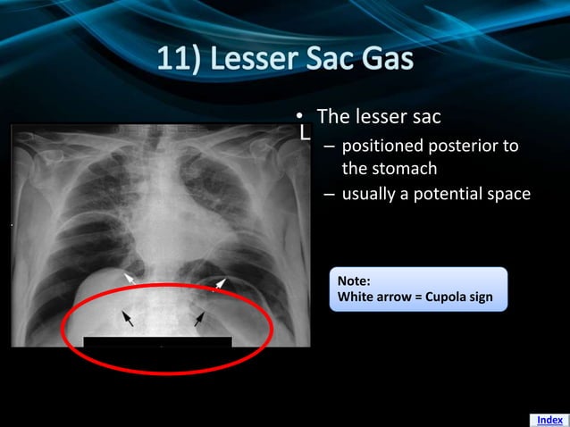 Signs of Pneumoperitoneum on Plain Film | PPTX | Lung and Respiratory ...
