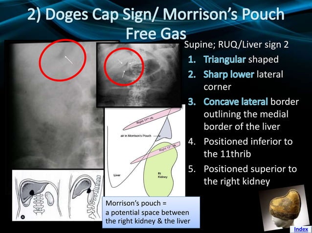 Signs of Pneumoperitoneum on Plain Film | PPTX | Lung and Respiratory ...