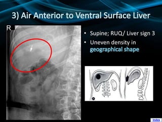 Signs of Pneumoperitoneum on Plain Film | PPTX