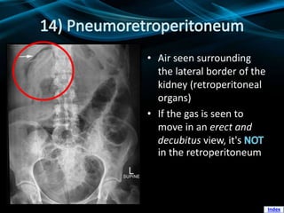 Signs of Pneumoperitoneum on Plain Film | PPT