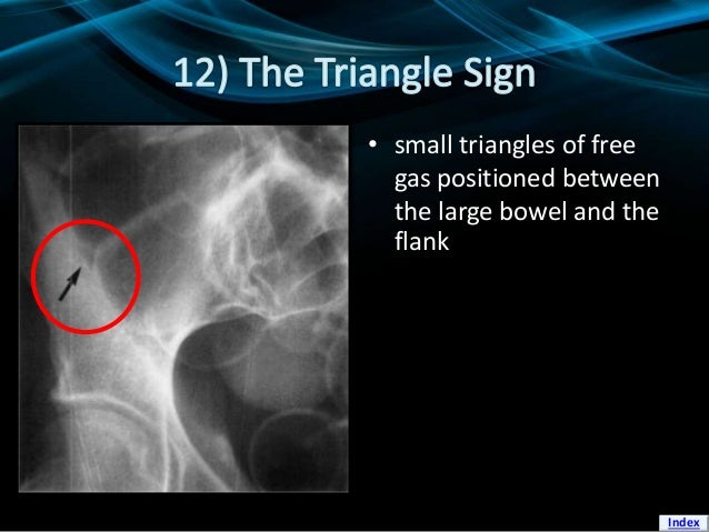 Signs of Pneumoperitoneum on Plain Film