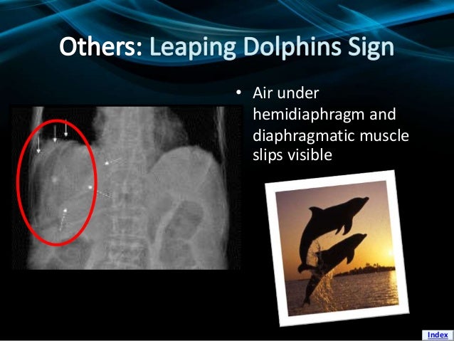 Signs of Pneumoperitoneum on Plain Film